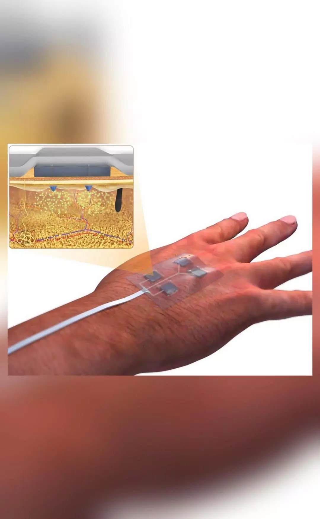 Scientists create 'smart' bandages to heal chronic wounds | Science ...